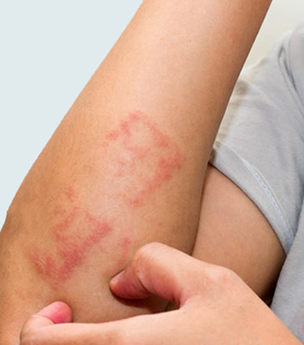 Does A Resident At Your Facility Have Untreated Cellulitis Eldercare