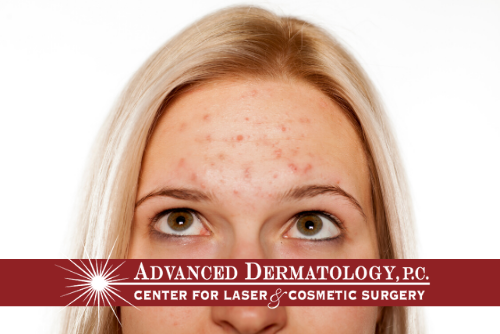 Dr. Whitney Bowe: Teen Acne Tips