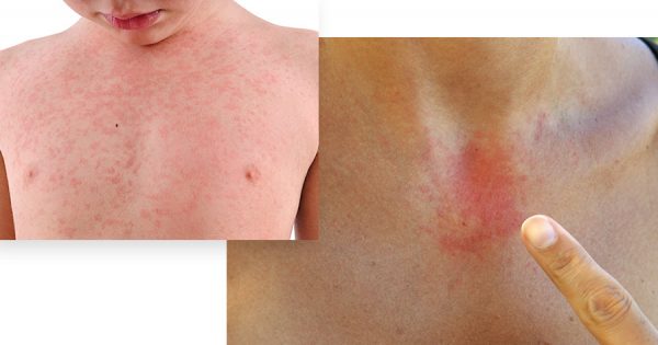 Contact Dermatitis | Advanced Dermatology, P.C. | NY, NJ, CT