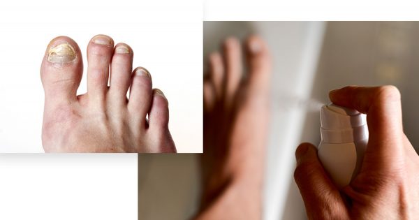 Tinea (Fungal Infection) Treatment in NY, NJ and CT