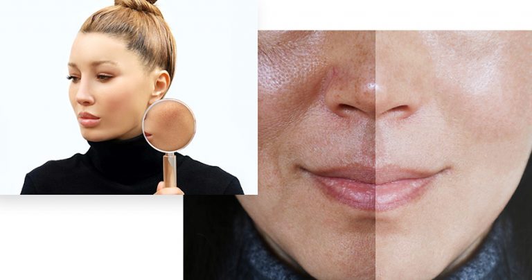Melasma Treatment in New York, New Jersey and Connecticut