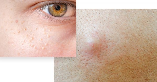 Treatment for Moles and Bumps | Advanced Dermatology, P.C.