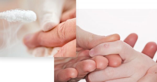 Wart Treatment in New York, New Jersey and Connecticut