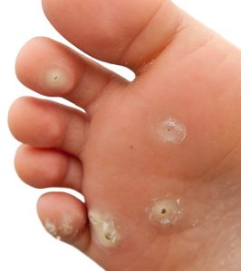 Wart Treatment in New York, New Jersey and Connecticut