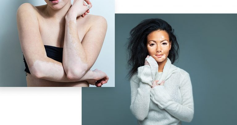 Vitiligo Treatment in New York, New Jersey and Connecticut