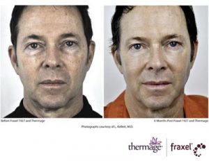 Thermage Skin Tightening Treatment in NY, NJ and CT