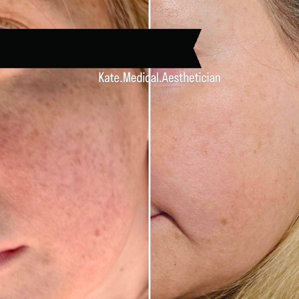 Kate Denise | Advanced Dermatology